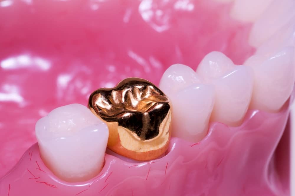 Do Permanent Gold Tooth Damage Your Tooth - Western Sydney Smiles